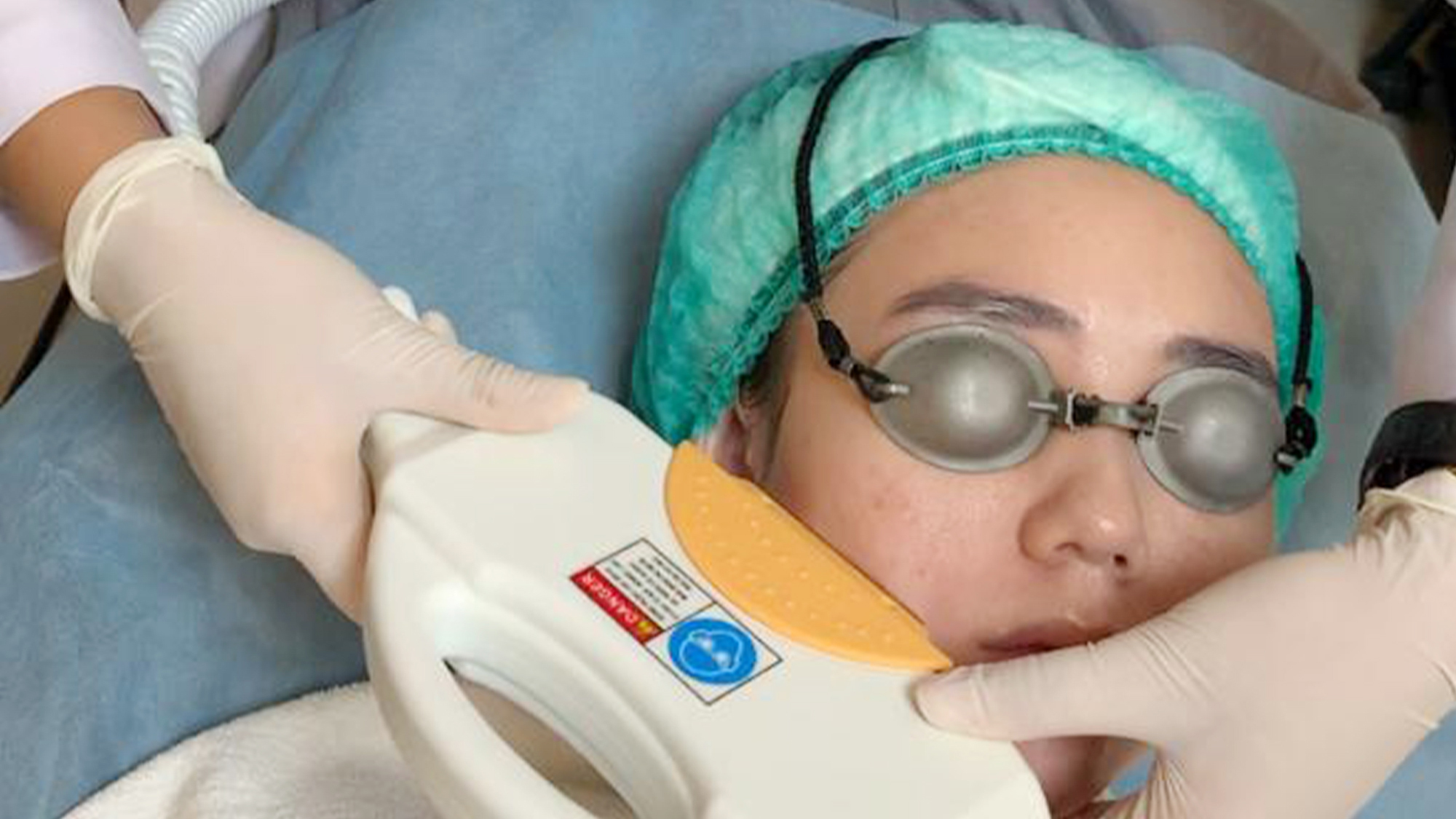 PHOTOFACIAL LASER - NanoGlow Aestetic Clinic