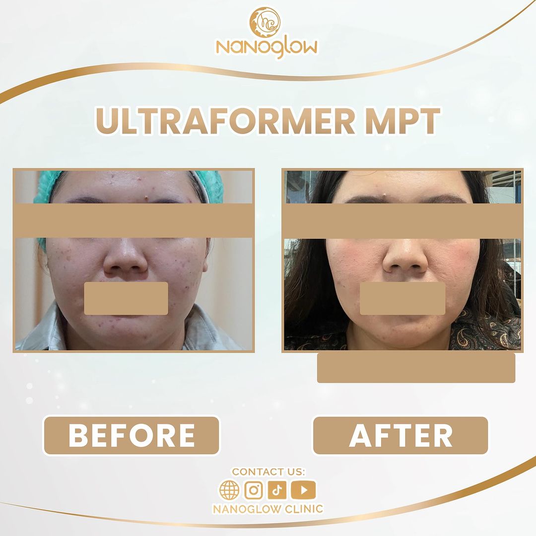 Perbedaan ULTRAFORMER MPT dengan VOLNEWMER - NanoGlow Aestetic Clinic